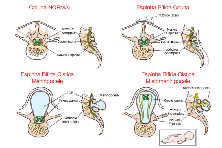 Espinha Bífida - FMFLA - Medicina Fetal